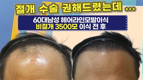 모발이식 60대 남성 헤어라인 모발이식 비절개 3500모 이식 전 후 Youtube