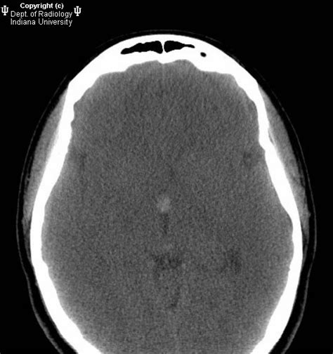 Neuroradiology On The Net Colloid Cyst