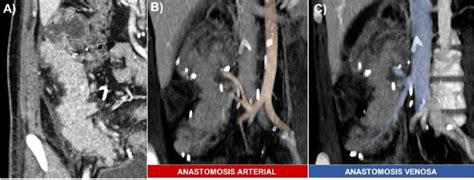 Hallazgos Normales En Tc De Abdomen Y Pelvis Con Contrasten Fases