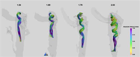 Pulsatile Tinnitus Causes And Treatments Ucsf Radiology
