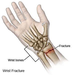 Wrist Fracture In Adults What You Need To Know