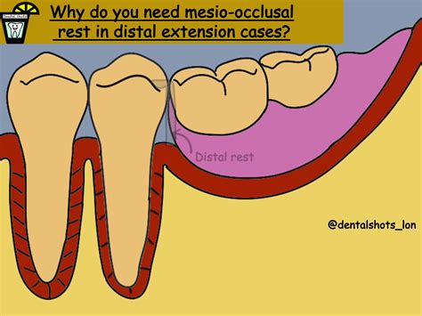 Why Do You Need Mesio Occlusal Rest In Distal Extension Cases In Case Of Distal Rest