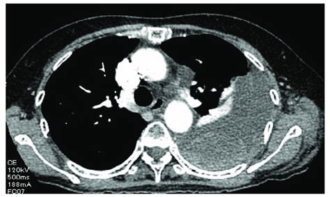 Contrast Enhanced Ct Scan Performed On The 4th Post Operative Day Left Download Scientific