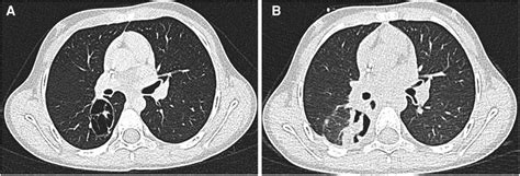 A B At Chest Ct A Right 46 × 30 × 35 Mm Ovular Expansive Pulmonary