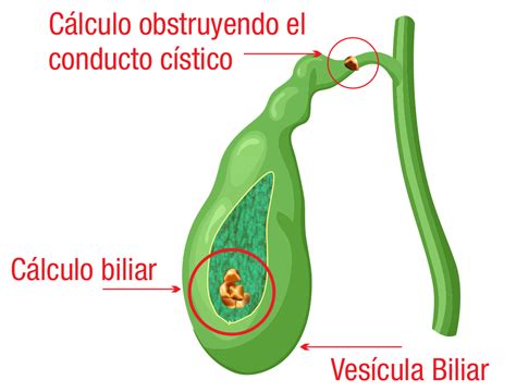 Piedras En La Vesícula Quirúrgicos Monterrey