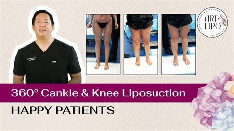 360° Cankle And Knee Liposuction Lipedema Surgery Artlipo Expert Dr