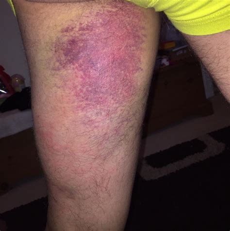 Grade Ii And Iii Hamstring Morgan Chiropractic Clinic Facebook