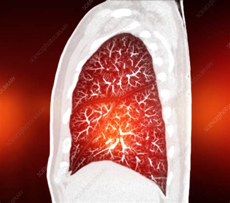 Normal Chest Ct Scan Stock Image F0460876 Science Photo Library