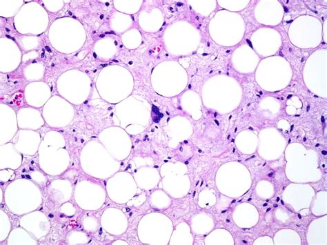 Atypical Lipomatous Tumorwell Diff Liposarcoma Lipoma Like