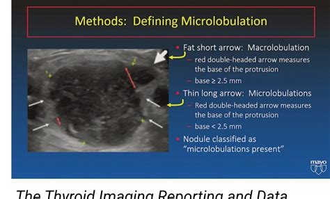 BÀi SoẠn VỀ SiÊu Âm ChẨn ĐoÁn Ti Rads Helps Classify Thyroid Lesions
