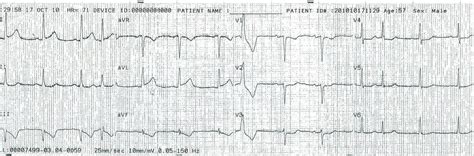 Dr Smith S ECG Blog Wait Until After The ECG To Give Nitroglycerine