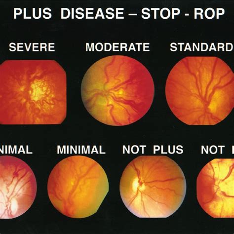 Progression To Threshold Rop By Ophthalmic Characteristics And