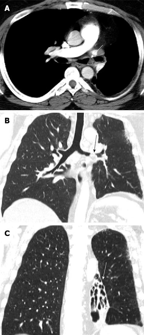 Figure 1 From Modern Imaging Of The Tracheo Bronchial Tree Semantic