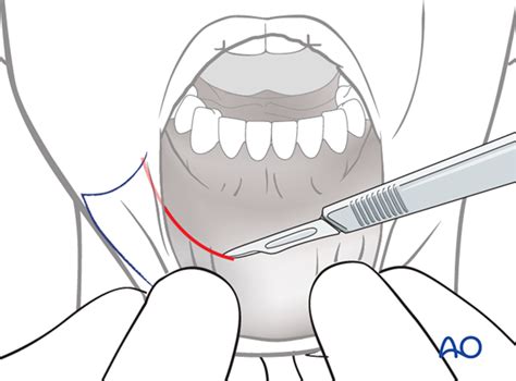 Contralateral Depressor Angularis Muscle Excision For Irreversible