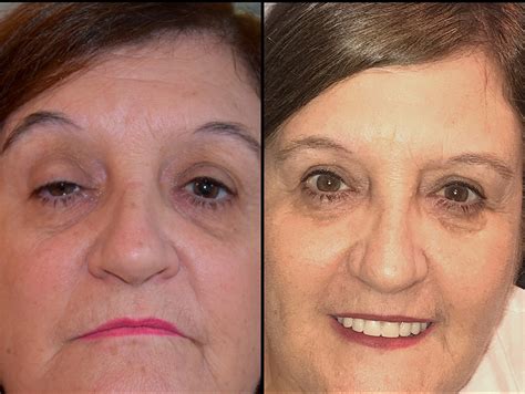 Párpado caído ptosis palpebral Consejo Argentino de Oftalmología