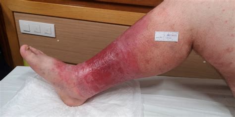 Que Es Celulitis Venosa