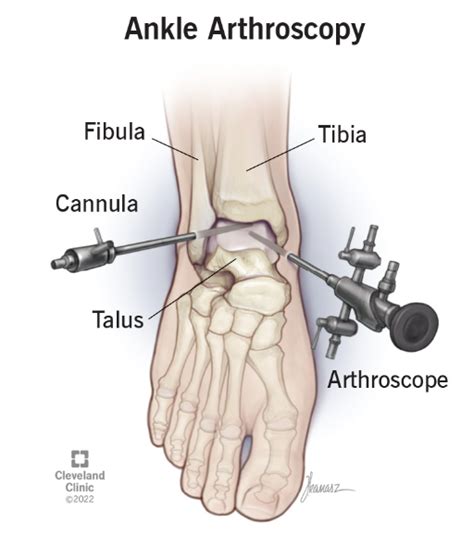 Ankle Synovitis Arthroscopic Debridement Texas Orthopedic And Spine