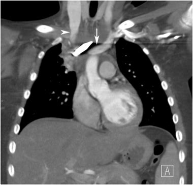 Coronal Computed Tomography CT Coronal CT Of The Chest With Download Scientific Diagram