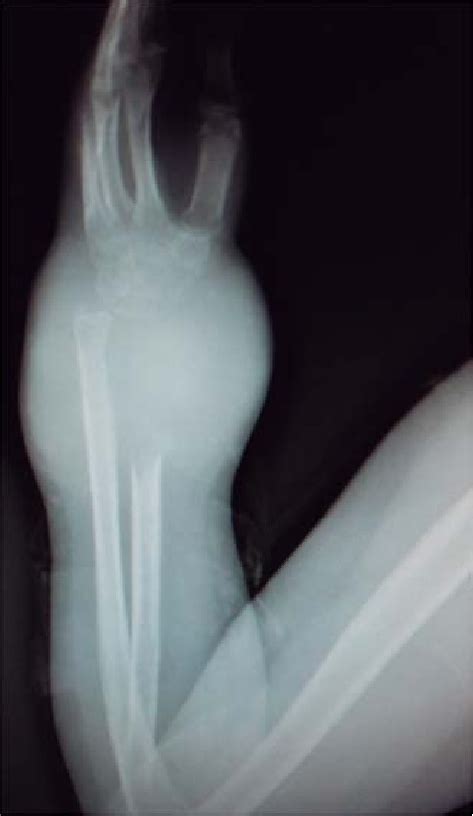 X Ray Showing A Lytic And Destructive Lesion Phantom Bone Sign In The