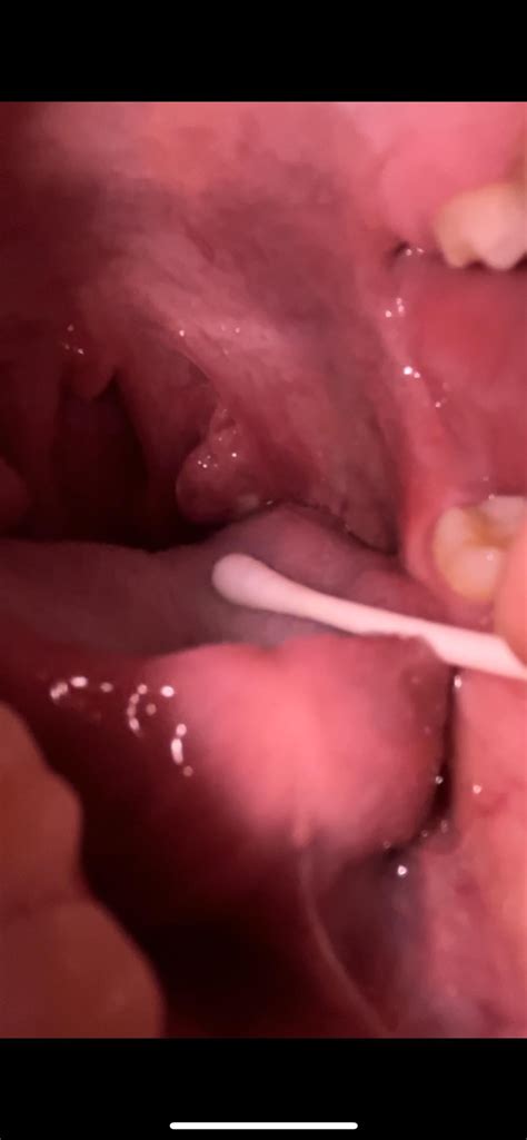 Tonsil Stone Cyst Rtonsilstones