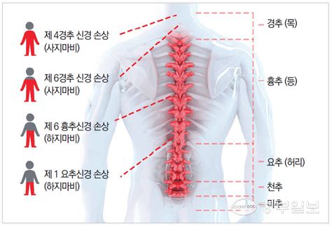 척수환자분 선생님 저 언제 걸을 수 있나요 네이버 블로그