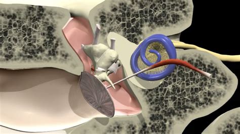 Glue Ear What Is Glue Ear