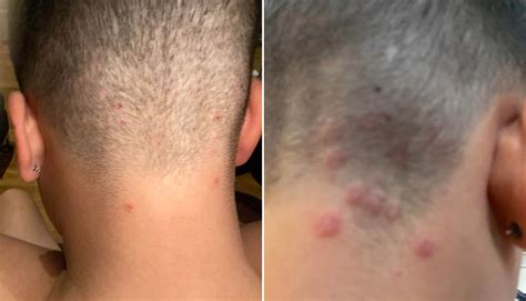 Urgent Warning After Shocking Number Of Ringworm Infections From