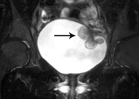 Inflammatory And Nonneoplastic Bladder Masses Radiologic Pathologic Correlation Radiographics