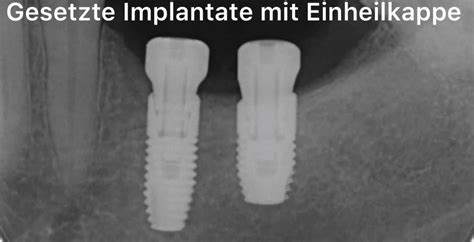 Implantologie Zahnarzt Dr Kirchhoff