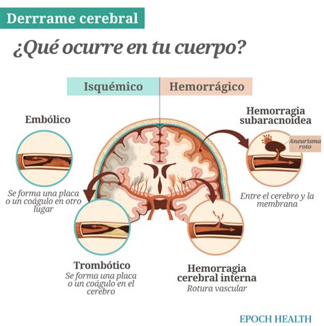 Guía esencial del accidente cerebrovascular síntomas causas