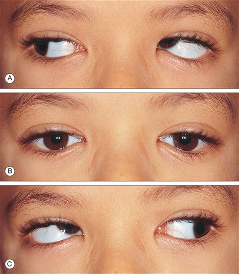 Other Vertical Strabismus Forms Clinical Tree