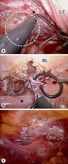 A Novel Technique For Ureteral Reimplantation With Broad Ligament