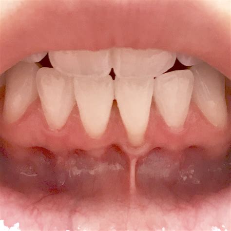 24 Autogenous Connective Tissue Graft The True Life Of A Dental