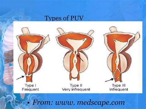 Posterior Urethral Valve Ppt Posterior Urethral Valve Ppt