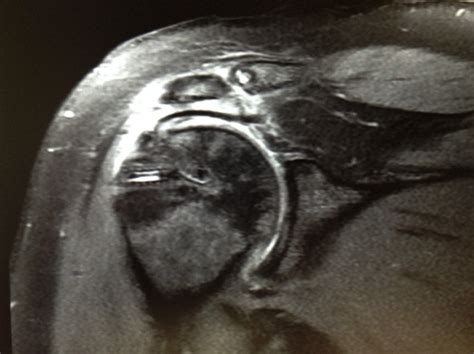 Postoperative Mri Arthrogram After A Rotator Cuff Bridging Procedure Postoperative Mri Arthrogram After A Rotator Cuff Bridging Procedure