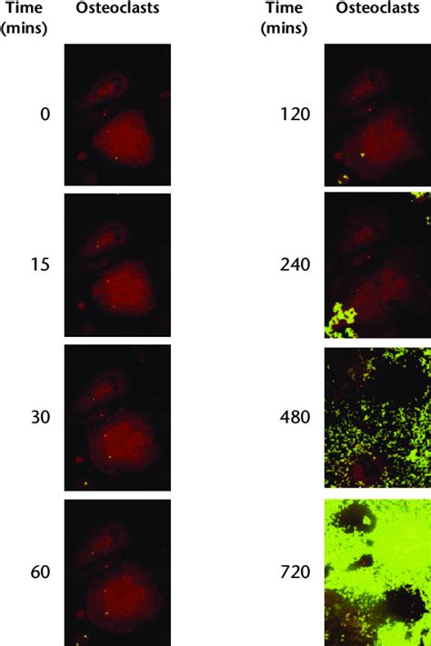Intracellular Penetration Of Mcherry Labelled Osteoclasts By Green