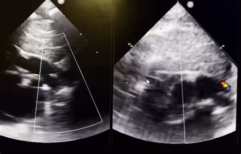 Andrei Satsuk Auf Linkedin Echo Echocardiography Pda Study Learn Heart Ultrasound