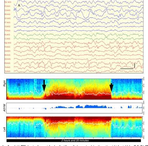 Figure 1 From Colour Density Spectral Array Of Bilateral Bispectral