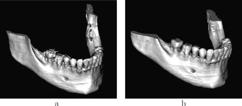 3D Jaw Reconstruction From Original A And Post Processed CT Data B