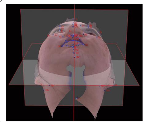 Differences In Soft Tissue Malar Height Between The Fractured And Download Scientific Diagram