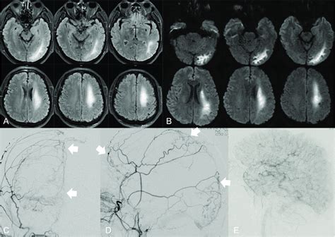 T2 Flair And Dwi With Dsa For Davf With Venous Reflux Located In The