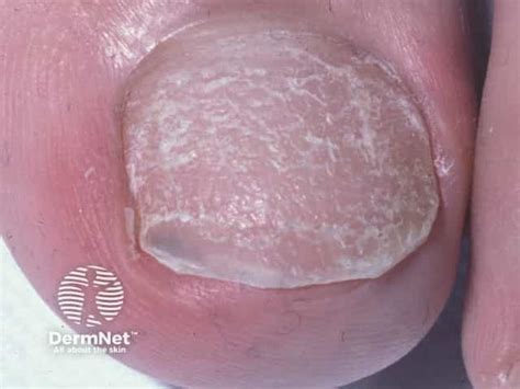 Nail Lichen Planus Images — Dermnet