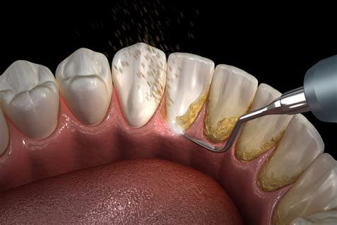 Hard Plaque On Teeth Causes Risks And Removal Options