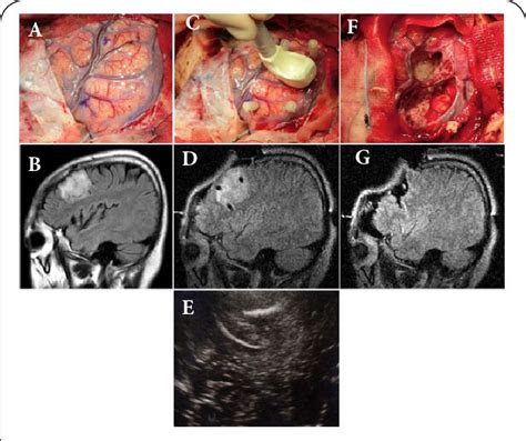 Representative Intraoperative Photographs A C E And Luid Attenuated