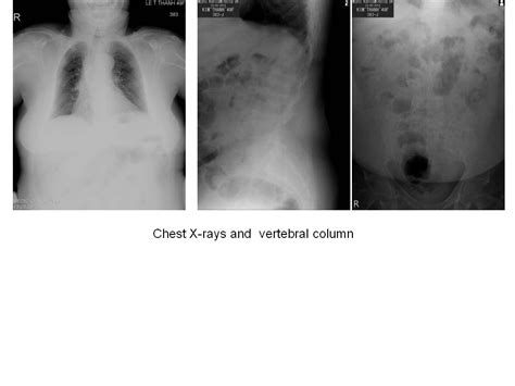 Vietnamese Medic Ultrasound Case 176 Parathyroid Tumor Dr HỒ ChÍ