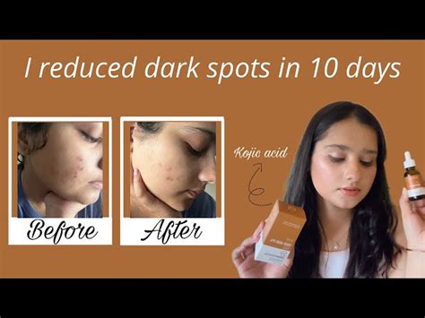 Kojic Before And After Melasma Kojic Soap Reduce Age Spot Freckles