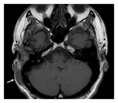 Mpnst Of The Right Postauricular Region A B Axial T1 And Download Scientific Diagram