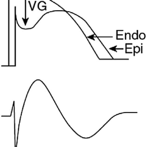 Ecg Stemi Ecg Showing An Anterolateral Stemi In A 68 Year Old Man With
