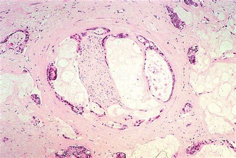 Photograph Neural Invasion Of Pancreatic Cancer Science Source Images