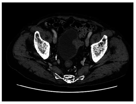 Submucosal Urothelial Bladder Cancer A Case Report Pmc